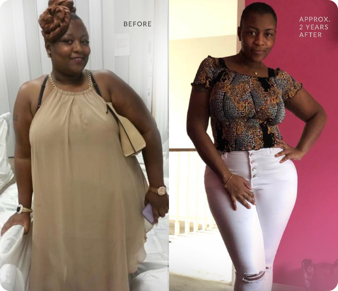Before & After Photos - Gastric Sleeve Surgery - 360 Sleeve