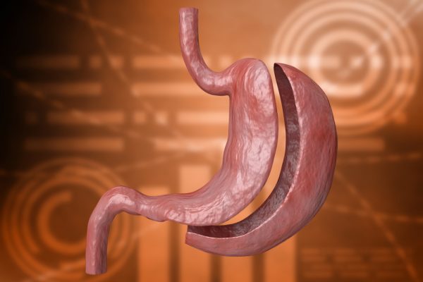 The Truth About Stomach Stretching After Gastric Sleeve Surgery