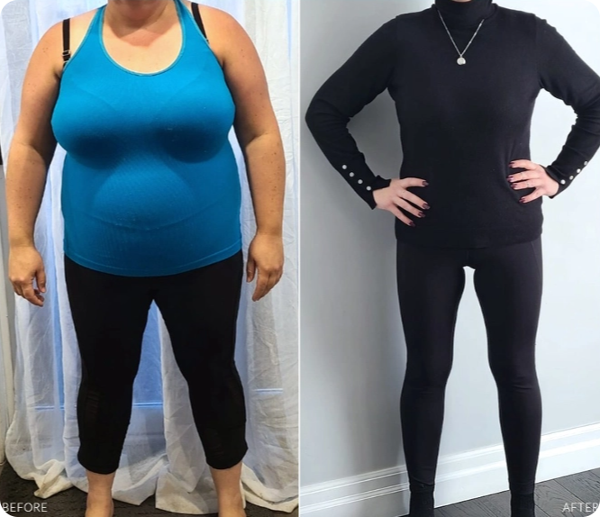 Before & After Photos - Gastric Sleeve Surgery - 360 Sleeve