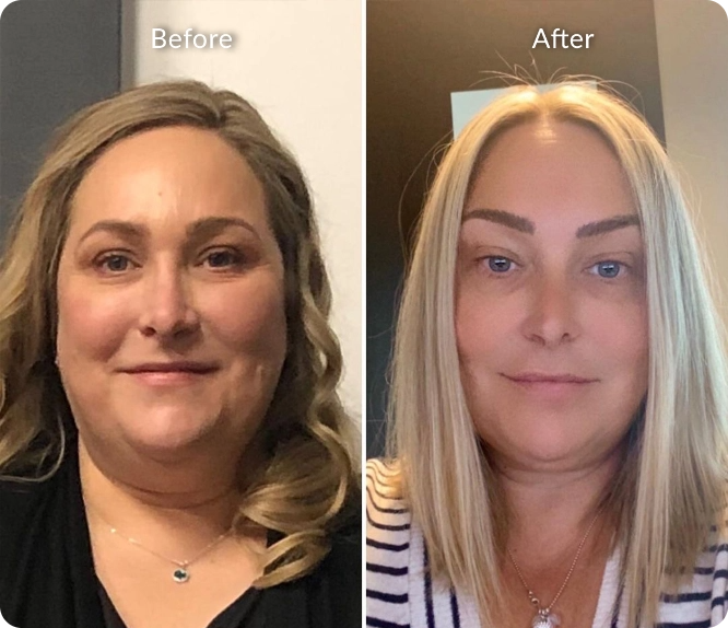 Before & After Photos - Gastric Sleeve Surgery - 360 Sleeve